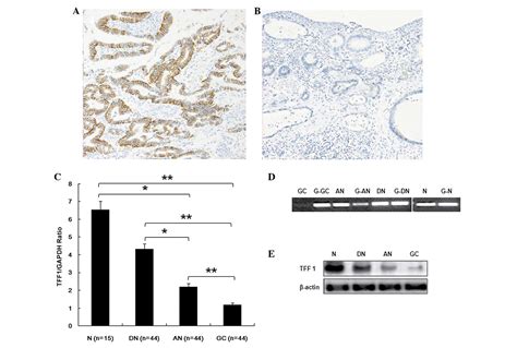 Dna Methylation Of Trefoil Factor 1 Tff1 Is Associated With The