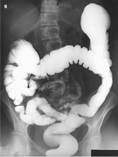 Chp Fluoro BE ERCP Flashcards Quizlet