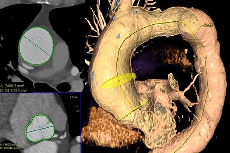Aortic Root Dilation