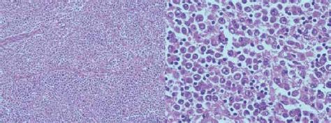 Diffused Large Cell Lymphoma Showing Diffuse Effacement By Large Cells Download High