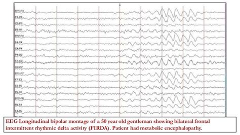 Abnormal Focal Eeg Patterns