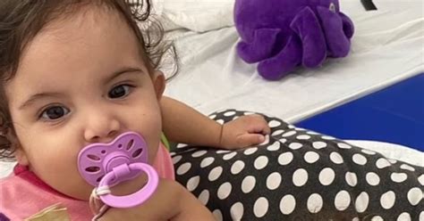 세 다리 공유한 샴쌍둥이 15시간 대규모 수술 끝에 분리 성공