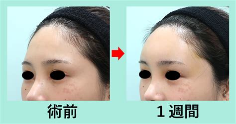 丸いおでこは美人の象徴 ダウンタイムの短いコンデンスリッチ脂肪注入術！ 東京・銀座の美容外科クリニック｜wom Clinic Ginza