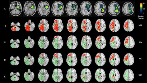 Tbss Analysis And Tumor Overlap Map For Left Sided Glioblastoma Download Scientific Diagram