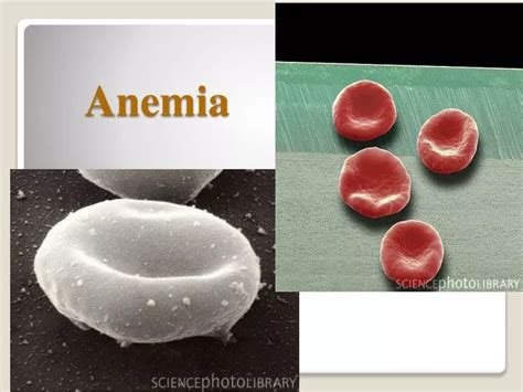 Ppt Anemia Powerpoint Presentation Free Download Id5701423