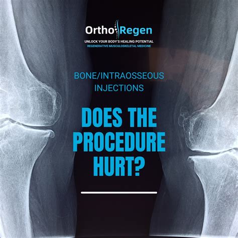 Orthoregen Dr Paul Schiavo Severe Osteoarthritis And Subchondral Bone Oedema Can Be