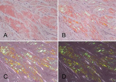 澱粉樣變性amyloid Degenerationwaxy Degeneration 小小整理網站 Smallcollation