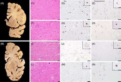 Neuropathological Analysis Of Cag Htt Pathological Expansion Carriers A Download Scientific