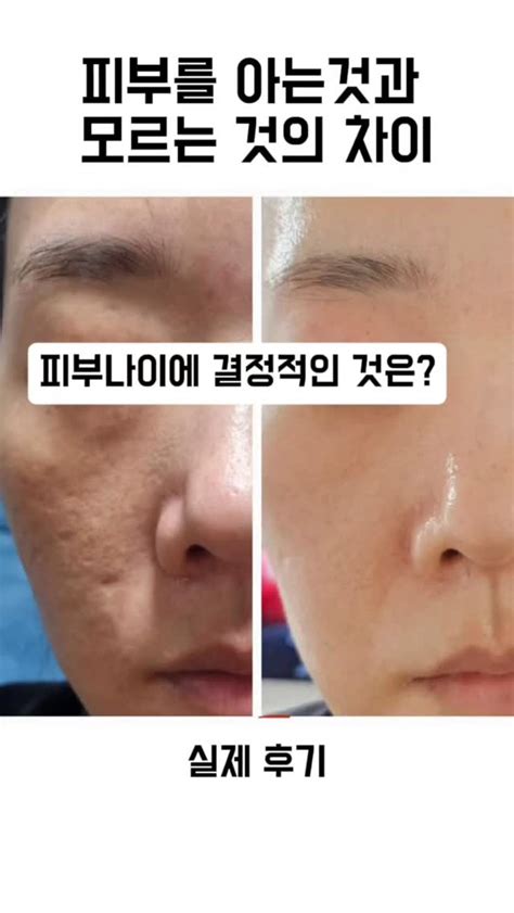 서승화 많이 알려져있는 관리가 무조건 좋은건 아니더라구요~ 피부 열이 높아지면 콜라겐생성에 직접적으로 관여하기 때문에 탄력도 떨어지고 모공도 넓어지지만 진짜 피부열을