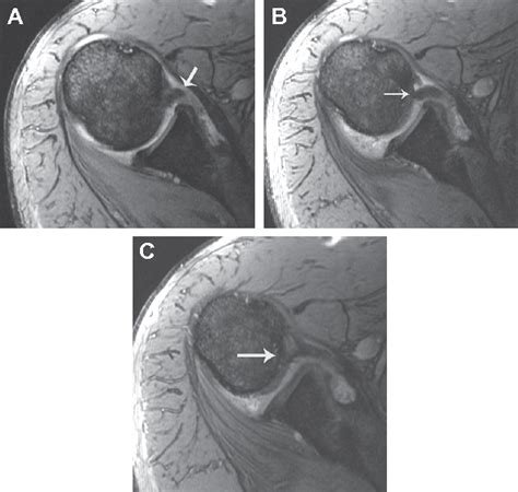 Figure 1 From Anterosuperior Glenoid Impingement Syndrome Semantic