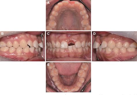 Figure 1 From Esthetic Anterior Restoration Using 3m Lavatm Esthetic