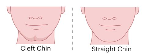What Causes Cleft Chin The Tech Interactive