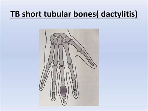 Tuberculosis Of Bone And Joints Ppt
