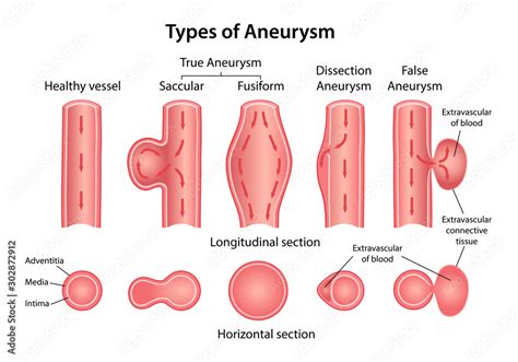 False Aneurysm