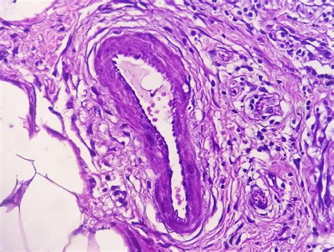Premium Photo Photomicrograph Of Granulomatous Tissue Histology