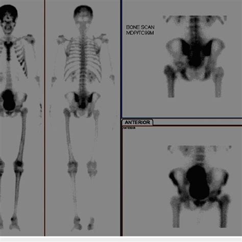 bone scan showing increased uptake in the pelvic region femur ribs