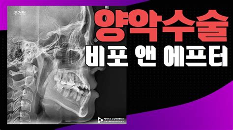 양악수술 비포 앤 에프터 Youtube