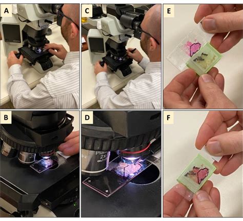 Amélioration Du Contenu Tumoral Grâce à La Macrodissection Tumorale