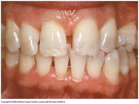 Chapter 7 Chronic Periodontitis Flashcards Quizlet