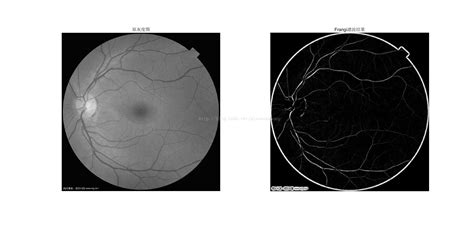 眼底图像血管增强与分割 （5）基于hessian矩阵的frangi滤波算法frangi Filtering Csdn博客