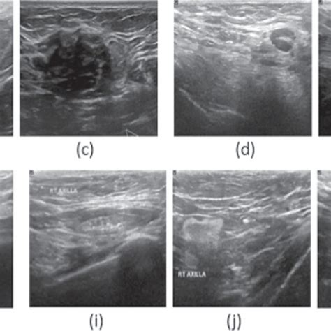 Samples Of Breast Ultrasound Images From Four Publicly Available