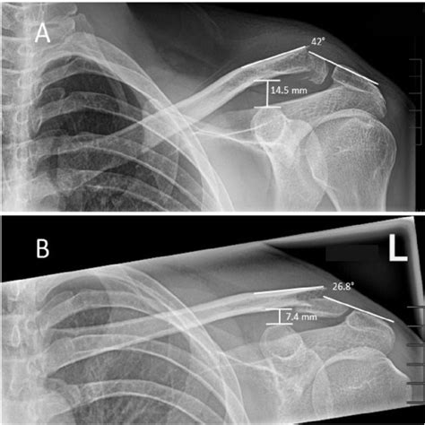 Evaluation Method Of The Fracture Angles And CCD In A P X Rays A