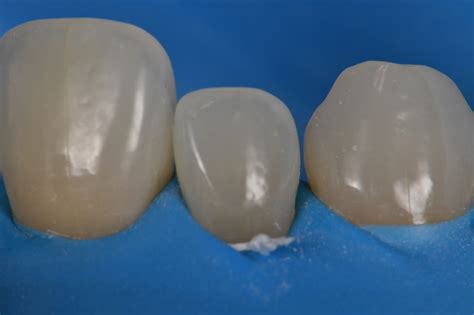Generating Translucency And Window Effects In A Composite Veneer