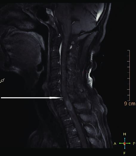 D1 Intramedullary Lesion Pointed With Arrow Download Scientific Diagram