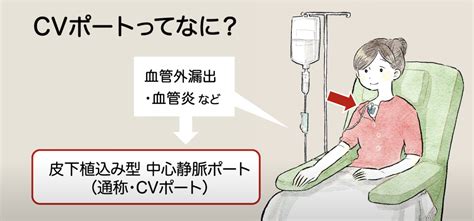 Cv Bc Tube