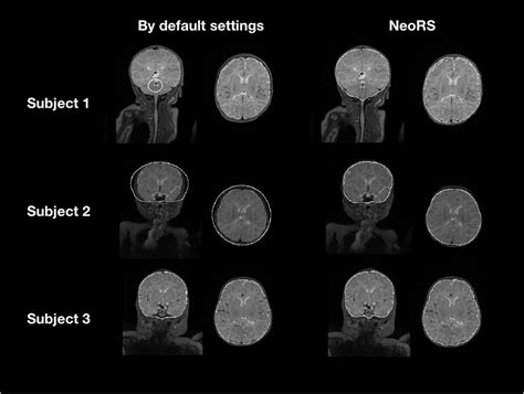 Neors A Neonatal Resting State Fmri Data Preprocessing Pipeline