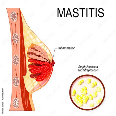 Mastitis Inflammation Of The Breast Abscess Formation Vector De