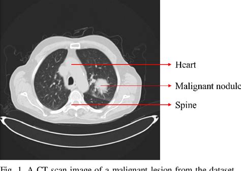 Figure 1 From Automated Lung Nodule Segmentation Using Federated Learning Through Ct Images