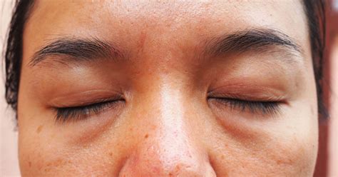 كيفية علاج تورم العين