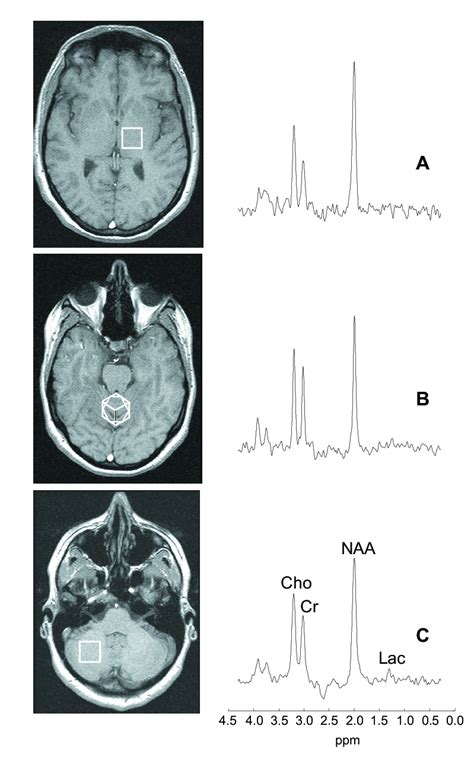 Voxel Positions In The Left Thalamus A The Vermis B And