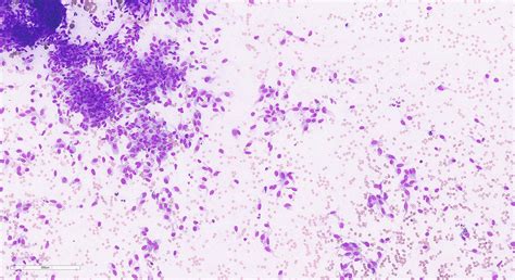 Spindle Cell Angiosarcoma At Pearline Beard Blog