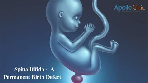 Spina Bifida A Permanent Birth Defect Apollo Clinic