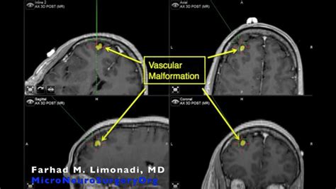 Brain Surgery Surgical Resection Of Vascular Malformation Cavernoma Youtube