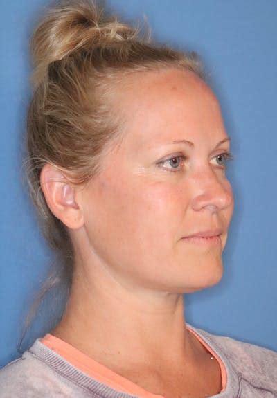 Cheek And Under Eye Filler Before And After Photos Dr Victoria Givens