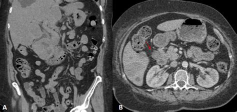 Acoronal Enhanced Ct Image Showing A Duodenal Exophytic Gist A Large