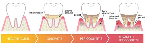 Advanced Periodontal Disease Before And After