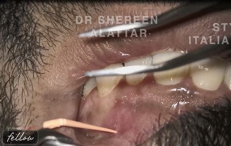Trace Every Tract Style Italiano Endodontics