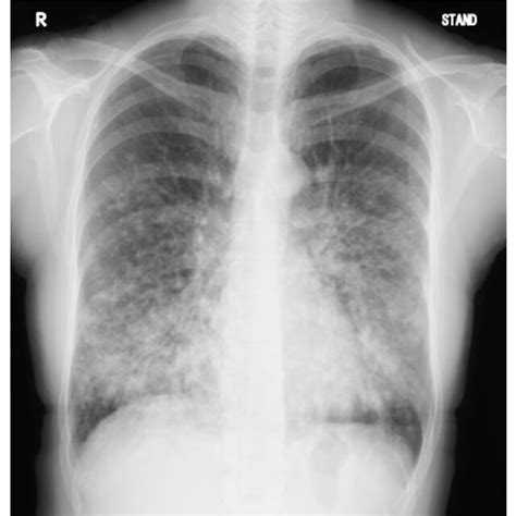 A Chest Radiograph Of The Patient At 39 Years Of Age Diffuse Nodules