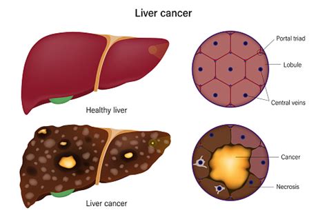 Liver Histology Normal Liver And Liver Cancer Liver Disease For Medical