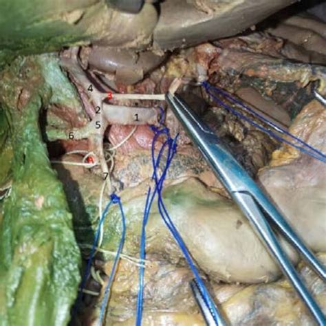 Common Hepatic Artery Branches 1 Common Hepatic Artery 2 Download Scientific Diagram