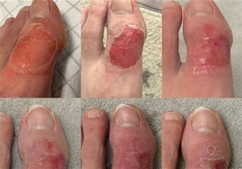 Specialist Guide To Managing Macerated Skin Wounds
