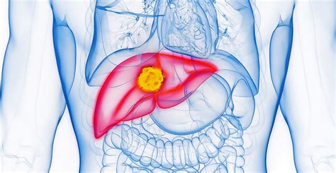 Liver Cyst Prof Dr Cengiz Pata