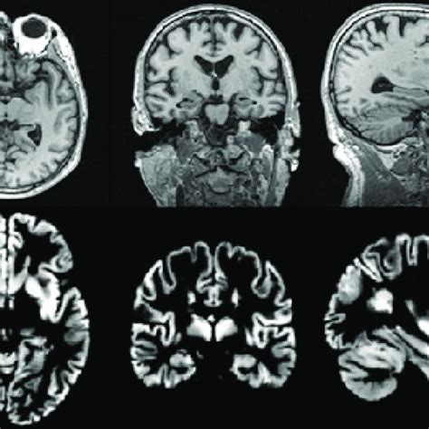 Axial T2 Weighted Image Showing Midbrain Atrophy Arrow And The Download Scientific Diagram