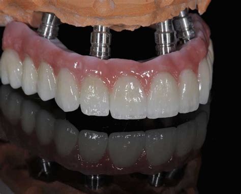 Smiledent Dental Studio Fufl Prettau Bridge Chrome™ Guidedsmile