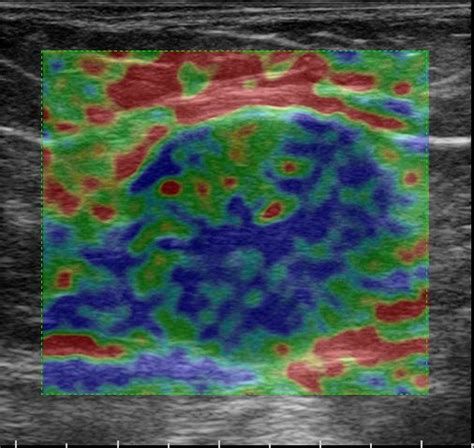 Melanoma Malignum Lymph Node Reporting And Data System LN RADS