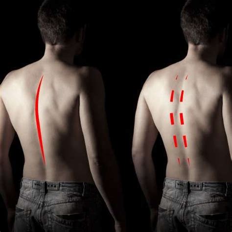 Spine Surgery Requirements Types Read Our Blog CMW
